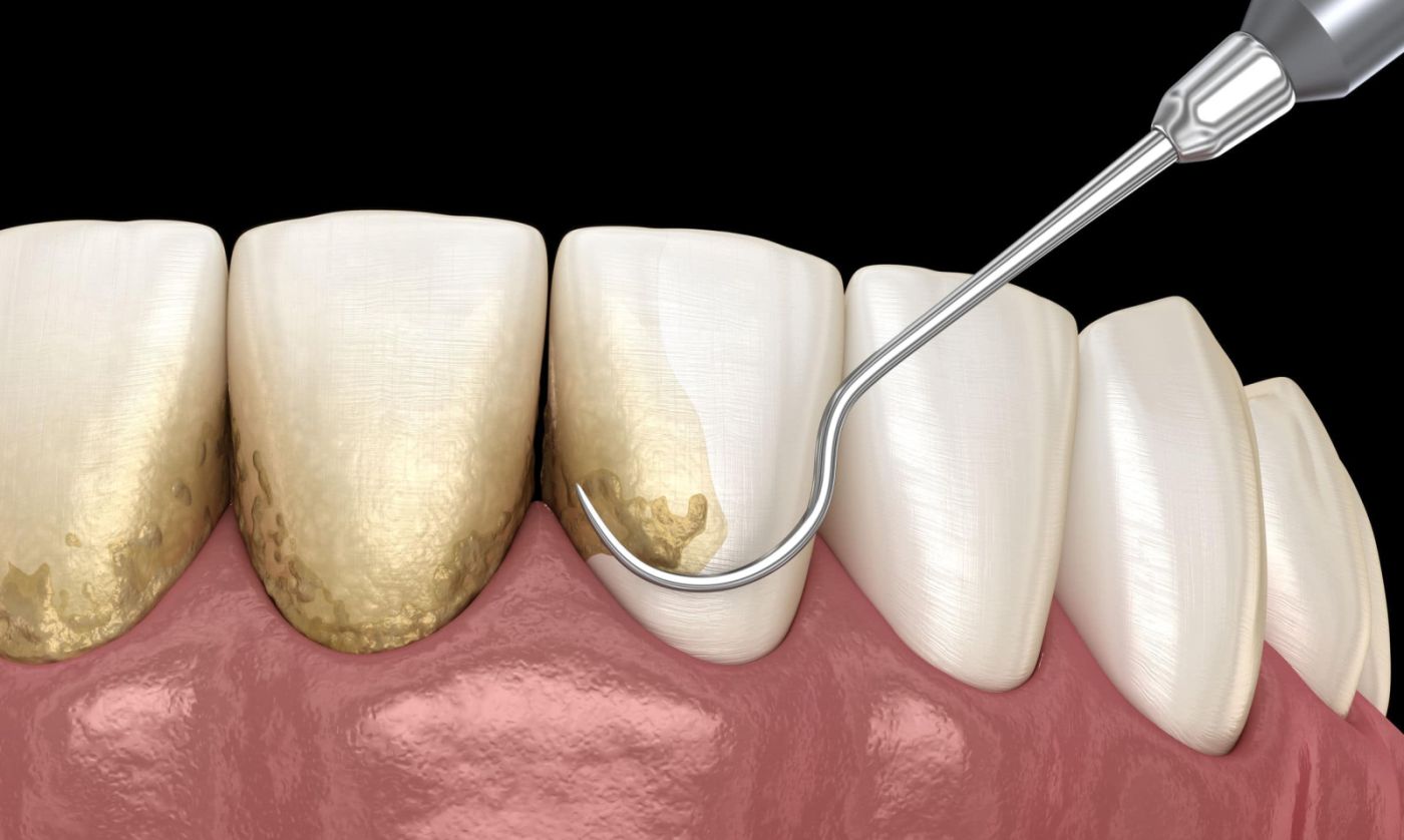 Cum se formeaza tartrul dentar si cum se poate preveni?