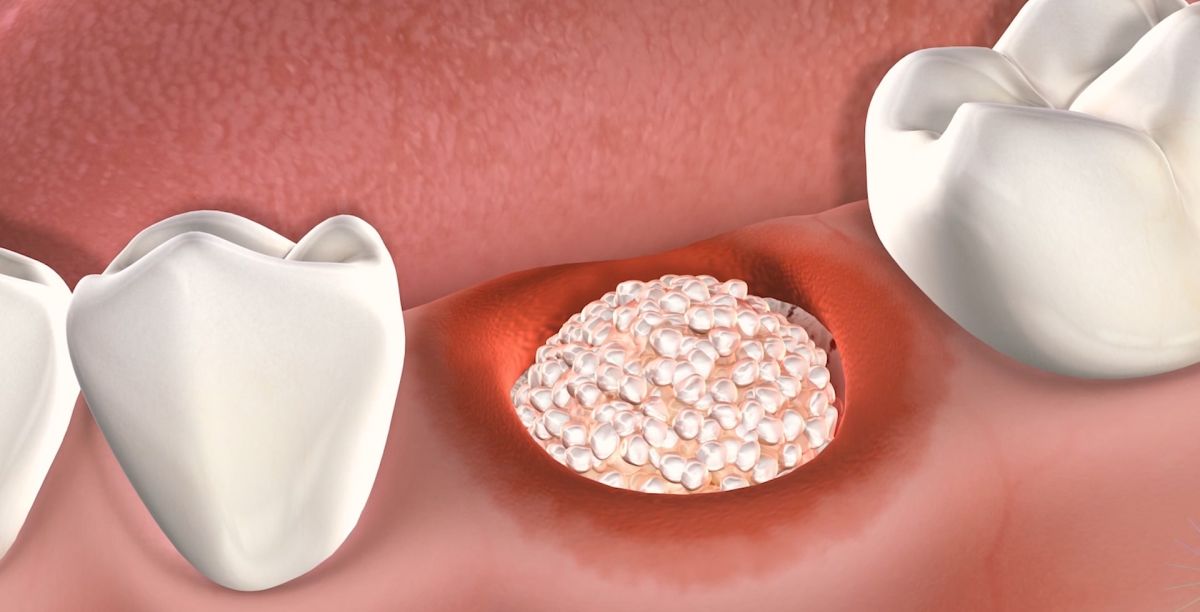 Aditie de os dentar | Augmentare osoasa pret | Dental Premier