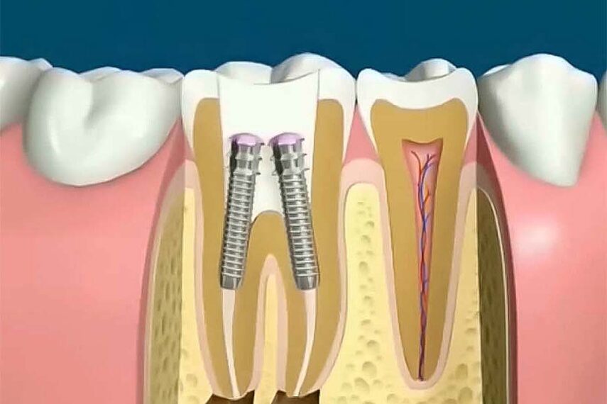 Implant dentar versus Pivot dentar | Dental Premier
