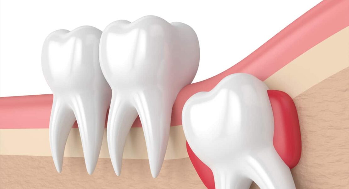eruptie masea de minte Archives – Dental Premier - Clinica ...