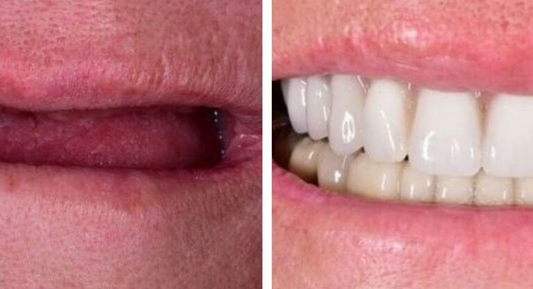Implanturi dentare subperiostale | Specializare Dental Premier