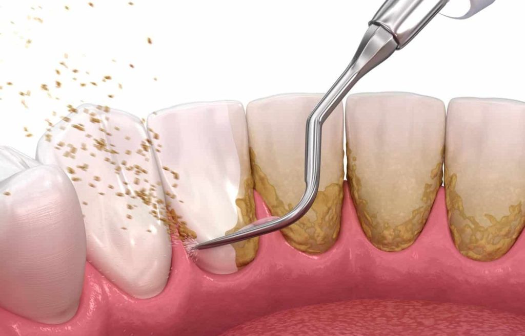 Afla ce este tartrul dentar si ce implica tehnica de detartraj! Dental ...