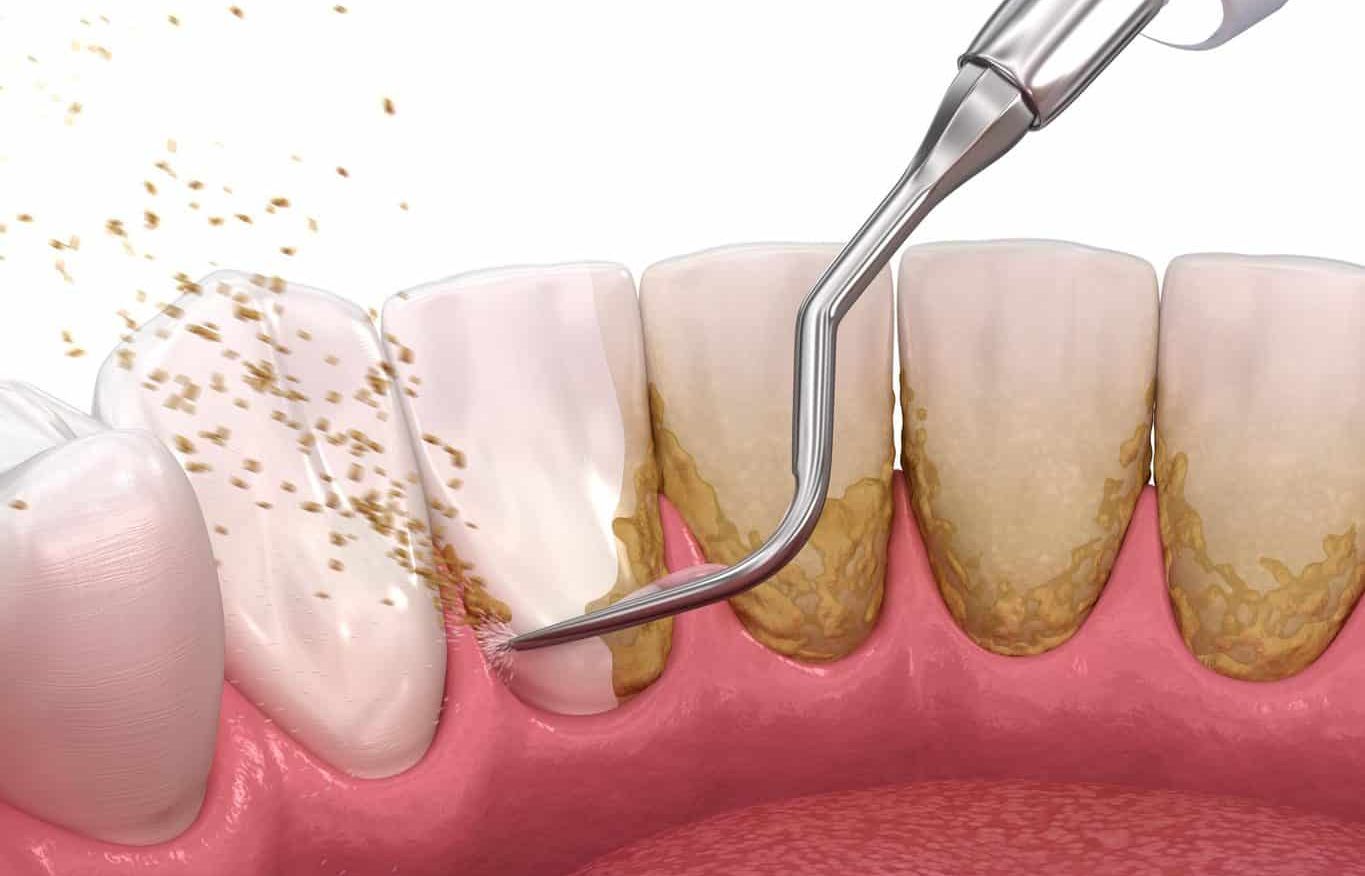 Afla ce este tartrul dentar si ce implica tehnica de detartraj! Dental ...