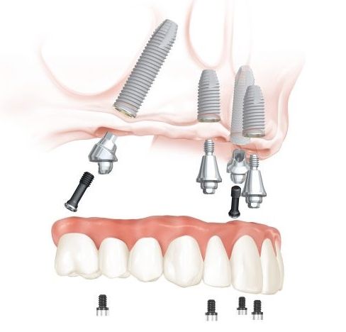 Bonturile protetice: tipuri, bont de vindecare, Multi-Unit | Pret bont ...