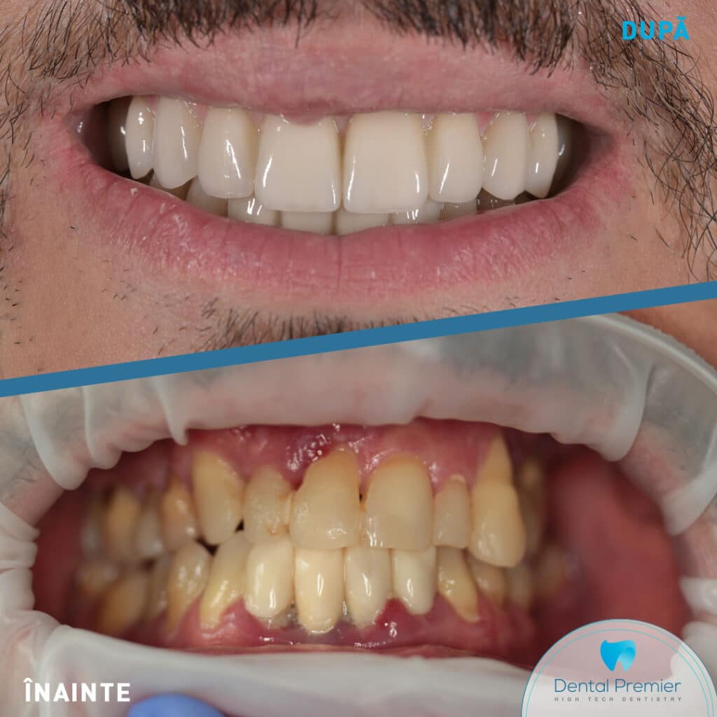 Proteza dentara elastica | Dental Premier