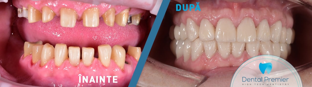 Fatete dentare: tipuri, indicatii, pret, pareri | Dental Premier