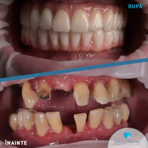 Tipuri de boli si afectiuni ale limbii | Simptome, tratament, poze