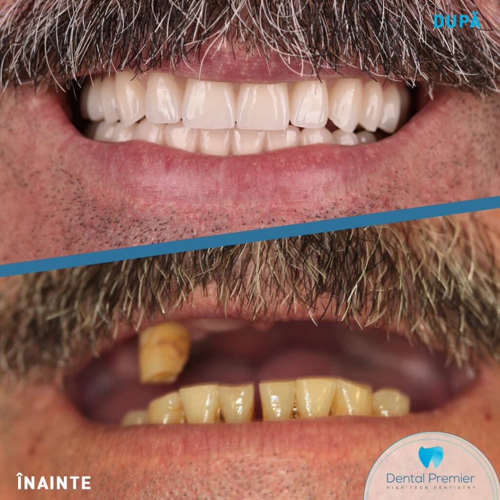 Proteza dentara elastica | Dental Premier