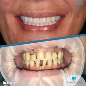 Proteza dentara elastica | Dental Premier
